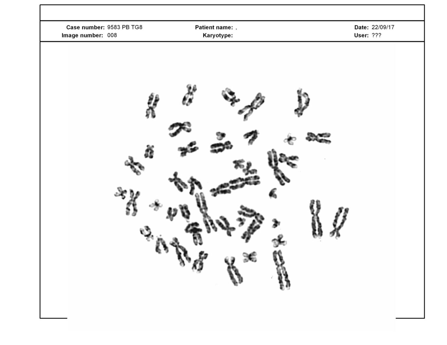 Examples of karyotyping – KaryotypingHub