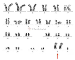 A karyotype of Klinefelter Syndrome- Explained – KaryotypingHub