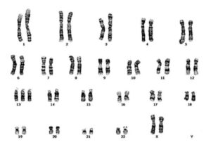 A karyotype of Patau syndrome- Explained. – KaryotypingHub