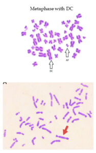 What is a Dicentric Chromosome?- Definition, Cause, Consequences ...