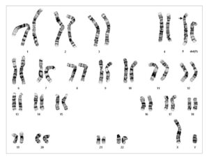 5p deletion syndrome: Why do they cry like a cat? – KaryotypingHub