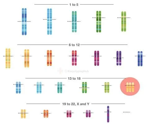 trisomy 18 karyotype notation
